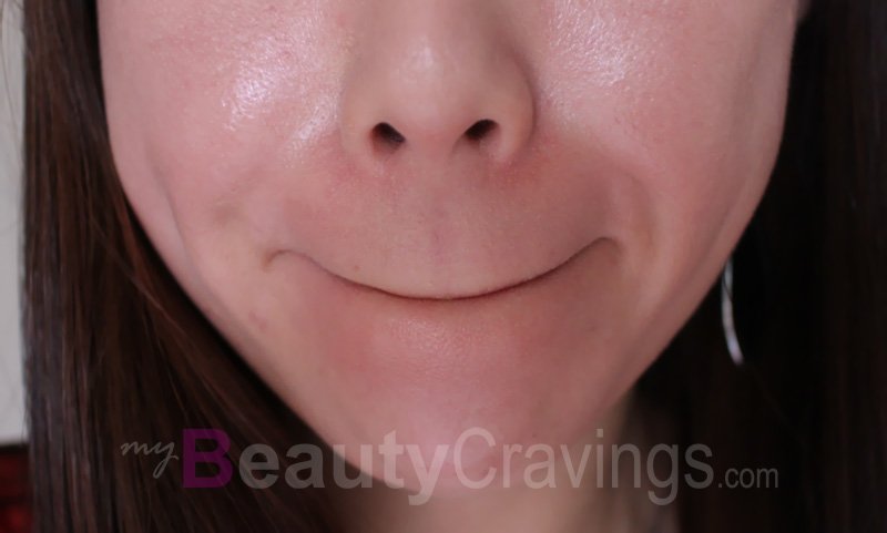 Chin Filler Treatment by Cutis Medical Laser Clinics | Part 2 - The ...