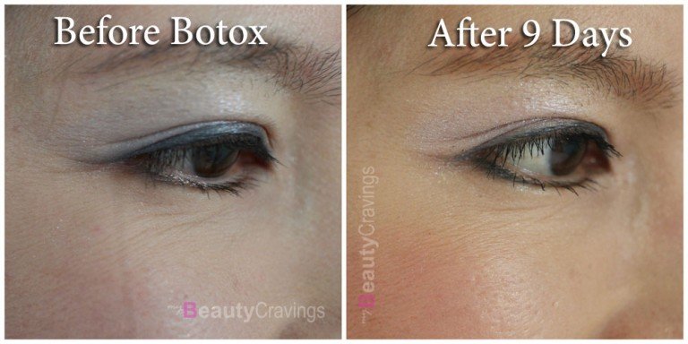Botox Before & After: How many units needed in 30s and 40s ...