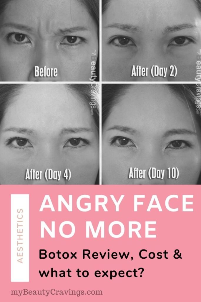 Botox Before & After: How many units needed in 30s and 40s ...
