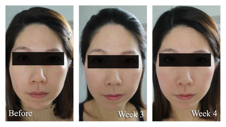Ultherapy Results: Before & After Photos show slimmer face and sharper ...