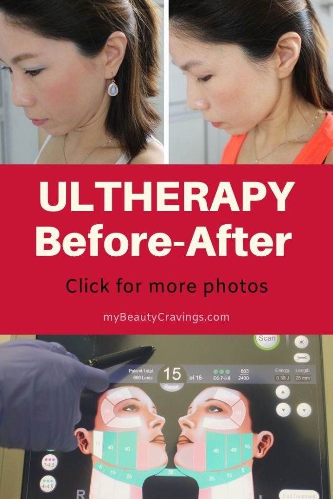 Ultherapy Results: Before & After Photos show slimmer face and sharper ...
