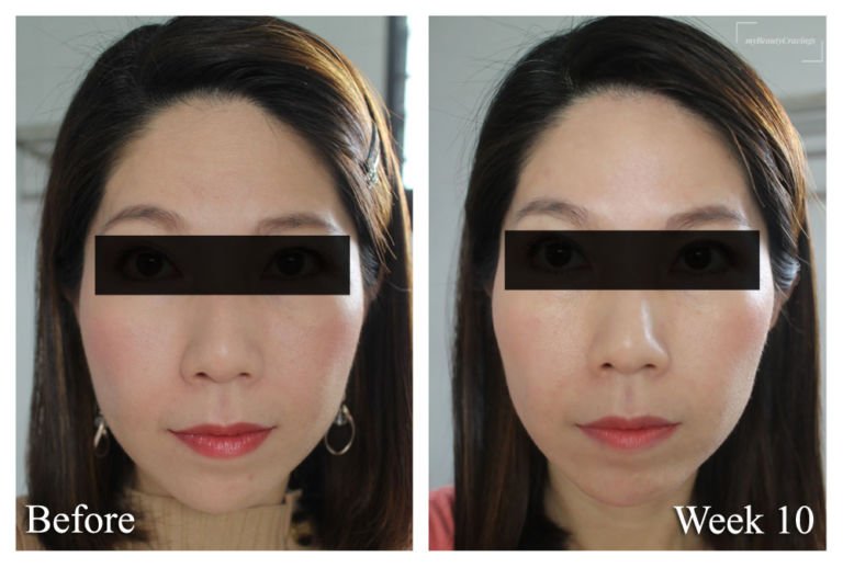 Ultherapy Results: Before & After Photos show slimmer face and sharper ...