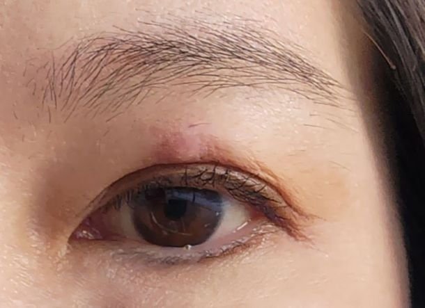 What a "memorable" eye stye recovery experience (includes tips to speed ...
