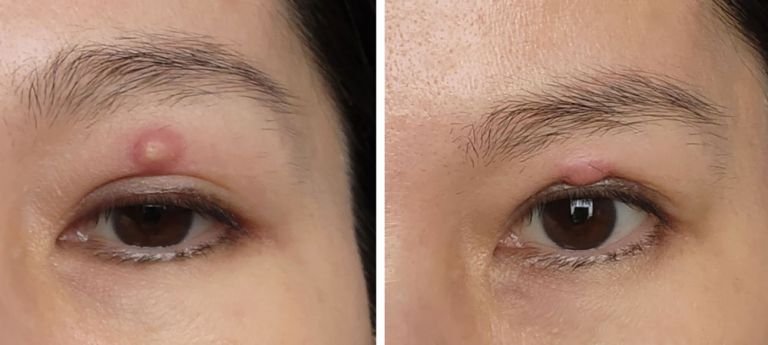 What a "memorable" eye stye recovery experience (includes tips to speed ...