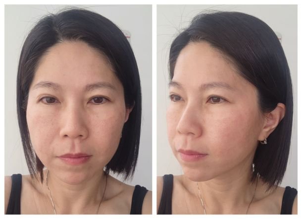 Secret DUO review: Tried this microneedling treatment and it shaved ...